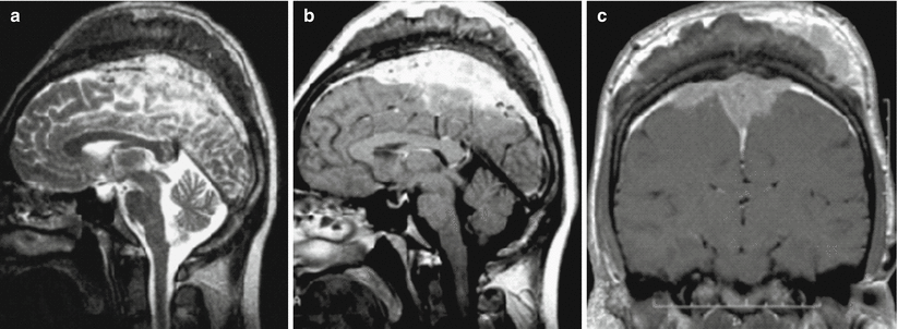 Meningioma Radiology Key Meningioma Radiology Key