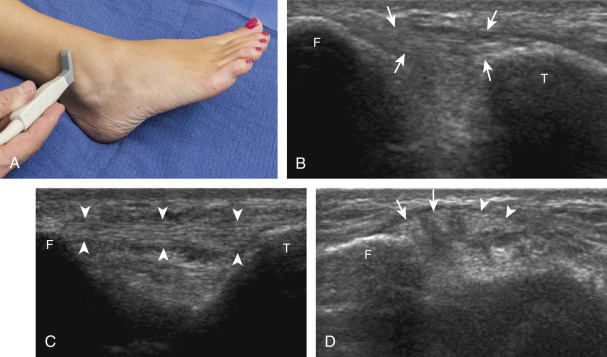 Ankle Foot And Lower Leg Ultrasound Radiology Key
