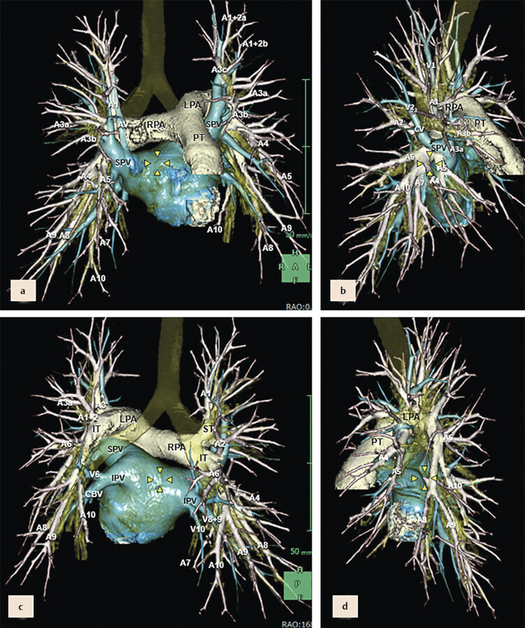 6 Pulmonary Artery And Vein Radiology Key 6 Pulmonary Artery And Vein Radiology Key