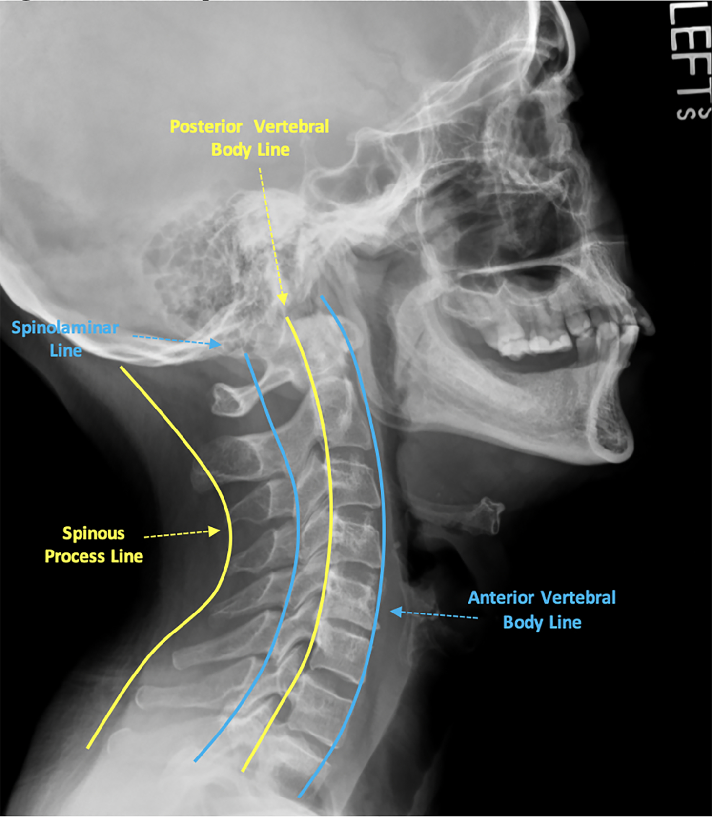 Subaxial Cervical Spine Plain Radiographs Radiology Key Subaxial Cervical Spine Plain Radiographs Radiology Key