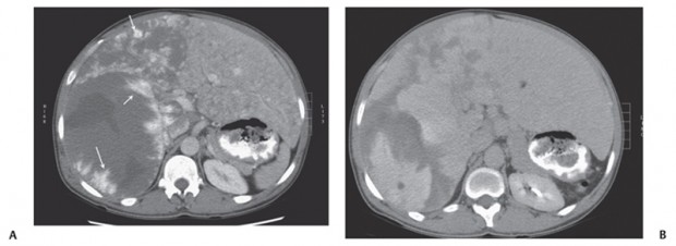 5 Pyogenic Liver Abscess | Radiology Key