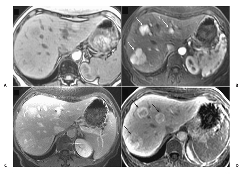 5 Pyogenic Liver Abscess | Radiology Key