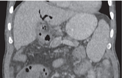 12 Acute Acalculous Cholecystitis | Radiology Key