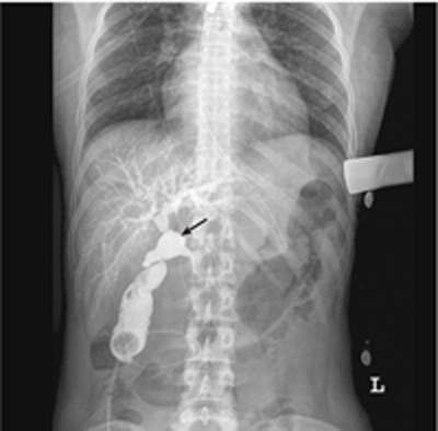 18 Choledochocele | Radiology Key