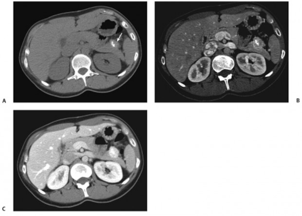 40 Acinar Cell Carcinoma of the Pancreas | Radiology Key