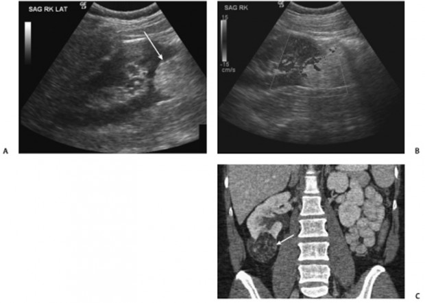 116 Focal Omental Infarction | Radiology Key
