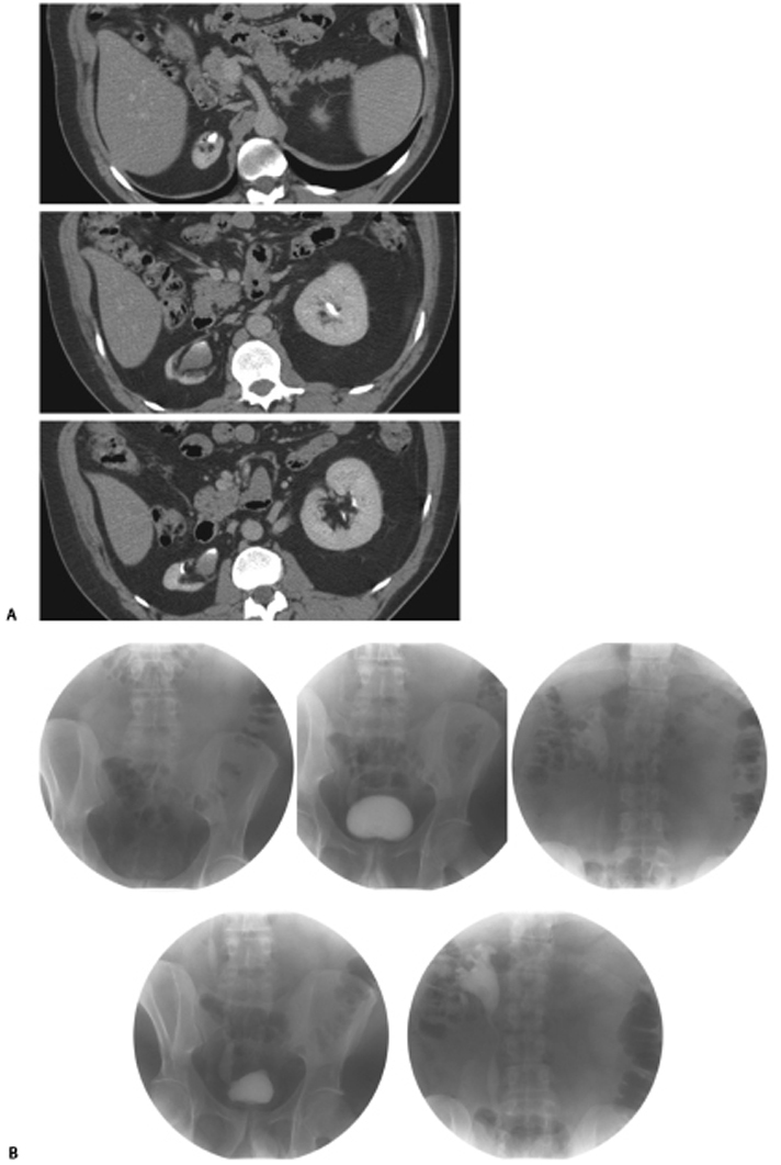 55 Atrophic Right Kidney Secondary to Reflux Nephropathy | Radiology Key