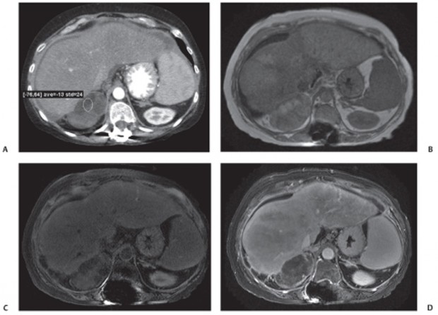 119 Lumbar Hernia of Grynfeltt | Radiology Key