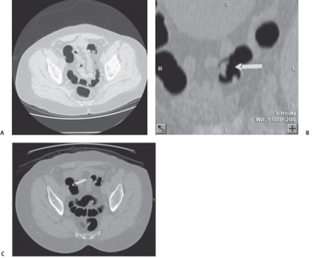 96 Lymphoma of the Sigmoid Colon | Radiology Key
