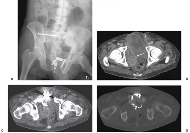51 Splenosis | Radiology Key
