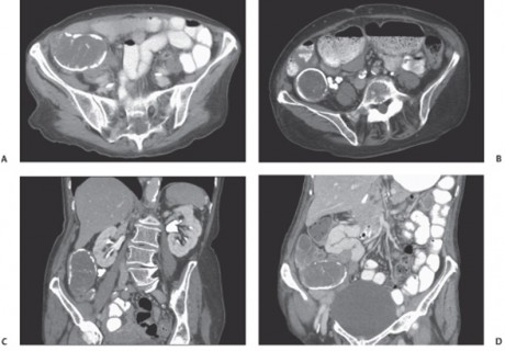 51 Splenosis | Radiology Key