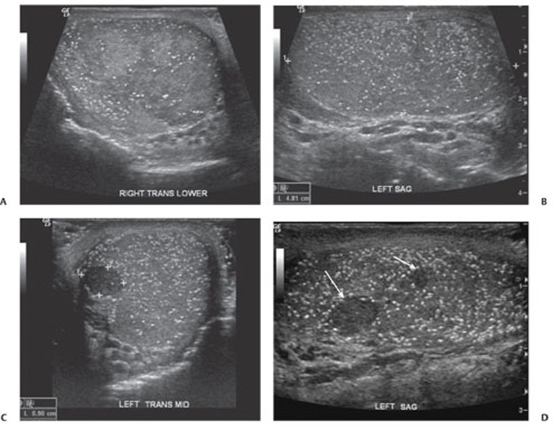 149 Tuberculous Epididymo-Orchitis | Radiology Key