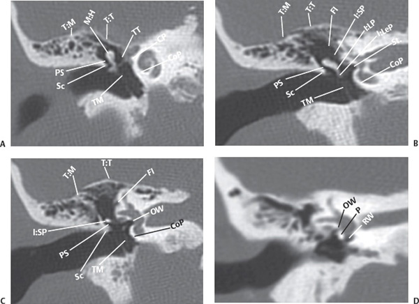 Middle Ear and Mastoid Air Cells | Radiology Key
