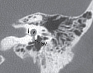 Inner Ear | Radiology Key