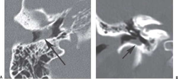 Cholesteatoma of the External Auditory Canal | Radiology Key