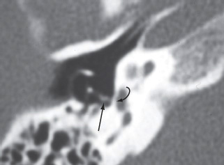 Petrous Apicitis | Radiology Key