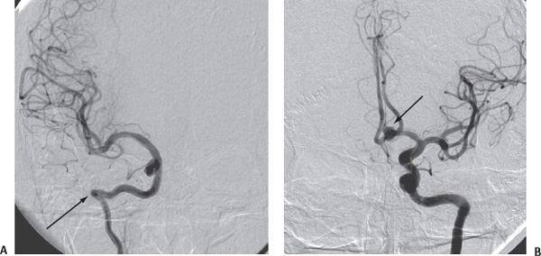 Aberrant (Intratympanic) Internal Carotid Artery | Radiology Key