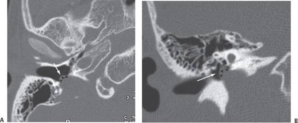 Dehiscent Jugular Bulb | Radiology Key