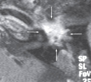 Acute Otitis Media and Mastoiditis | Radiology Key