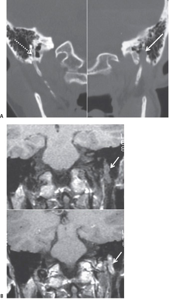 Chronic Otitis Media | Radiology Key