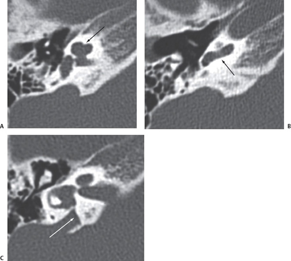 IV Inner Ear and Petrous Bone | Radiology Key