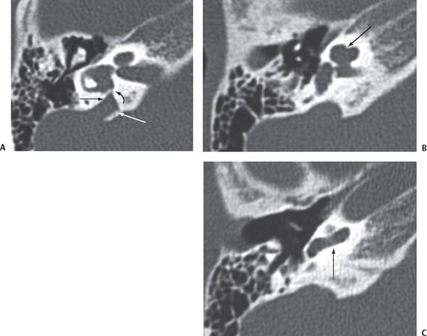 Large Vestibular Aqueduct Syndrome | Radiology Key
