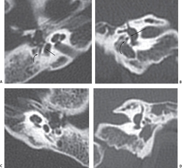 Oval Window Aplasia/Hypoplasia | Radiology Key