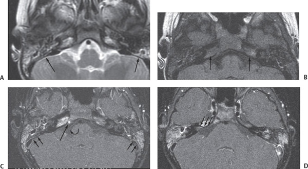 Petrous Apicitis | Radiology Key
