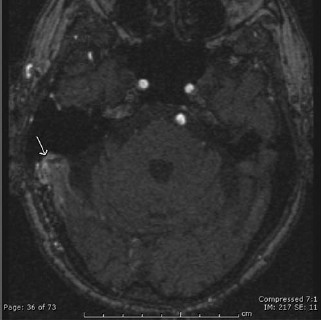Temporal Bone Imaging Technique | Radiology Key