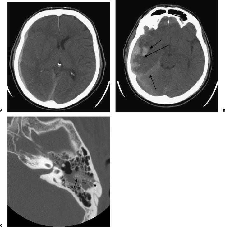 Temporal Bone Trauma | Radiology Key