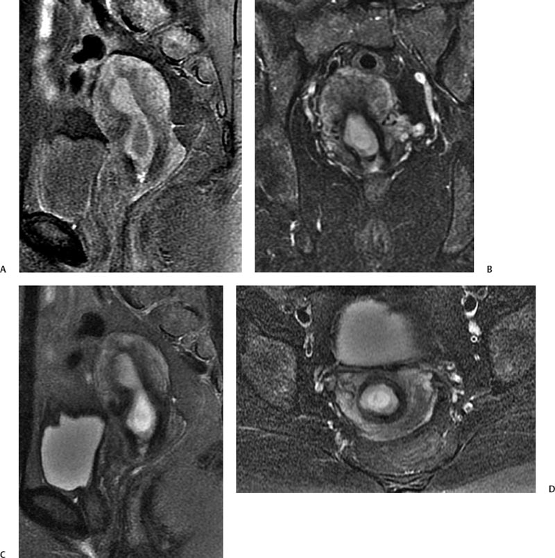 Applications of Pelvic Embolization Beyond Uterine Fibroid Embolization ...