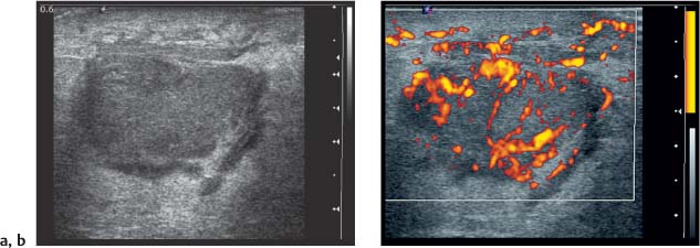 BI-RADS For Ultrasound | Radiology Key
