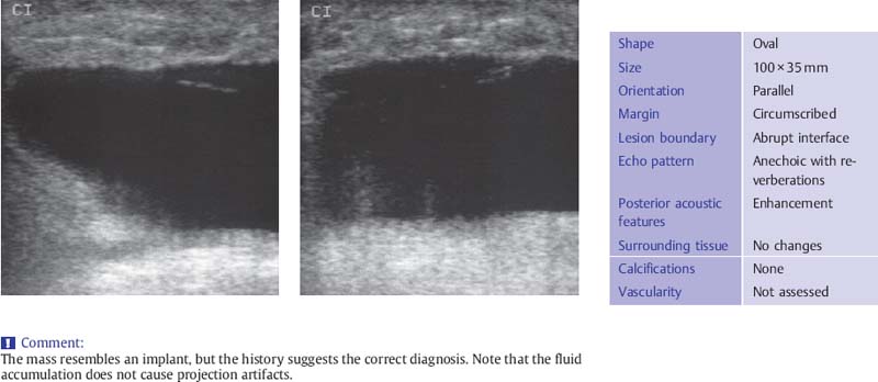 Breast Implants | Radiology Key