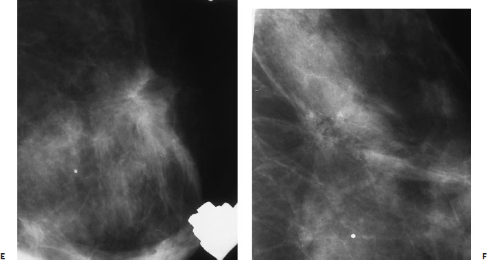 Approach to Mammographic Analysis | Radiology Key