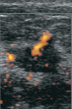 Irregular Masses: Malignant Masses | Radiology Key