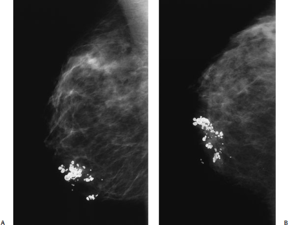 Calcifications: Round Lucent Center | Radiology Key