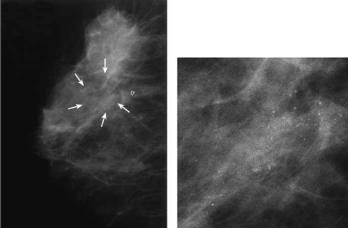 Calcifications: Small Round/Punctate | Radiology Key