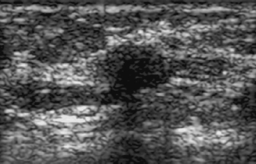Peripheral Architectural Distortion | Radiology Key