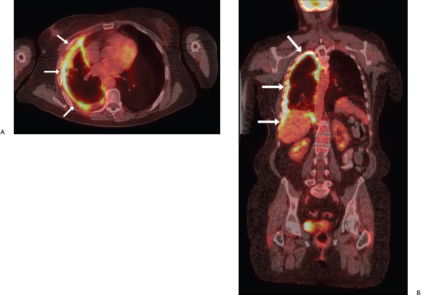 Additional Malignancies Radiology Key