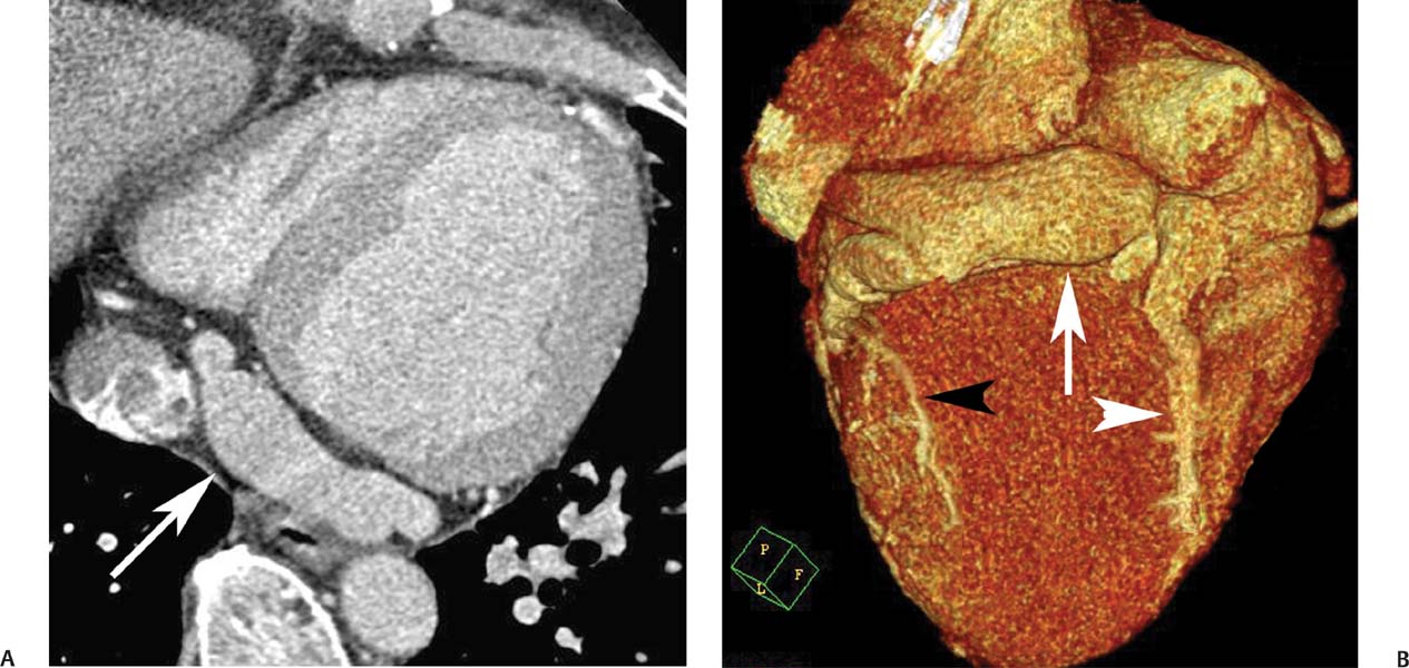 Ablation in the Left Atrium | Radiology Key
