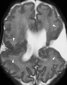 9 Schizencephaly | Radiology Key