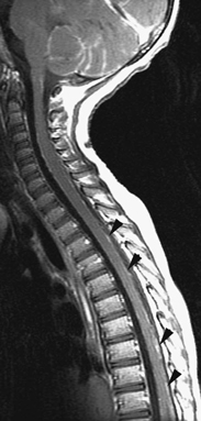 85 Neuroblastoma | Radiology Key