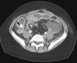 64 Appendicitis | Radiology Key
