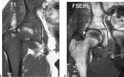 98 Leukemia | Radiology Key
