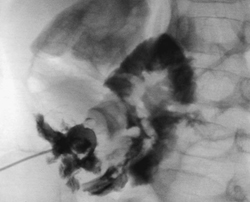 103 Abscess Drainage | Radiology Key