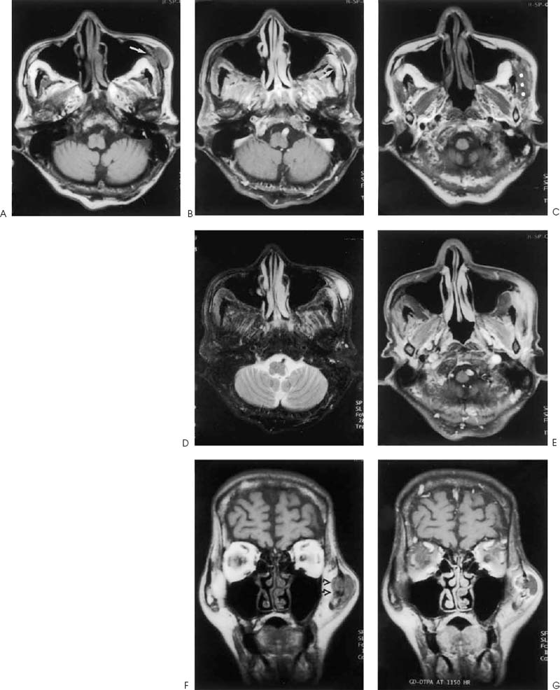 Tuberculosis | Radiology Key