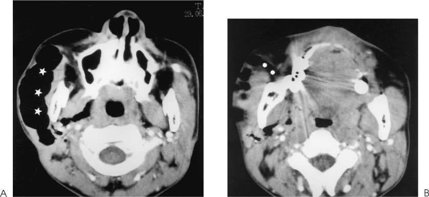 Pneumoparotitis | Radiology Key