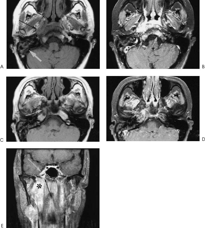 Nasopharyngeal Carcinoma | Radiology Key