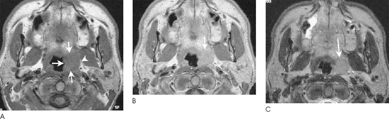 Squamous Cell Carcinoma of the Palatine (Faucial) Tonsil | Radiology Key