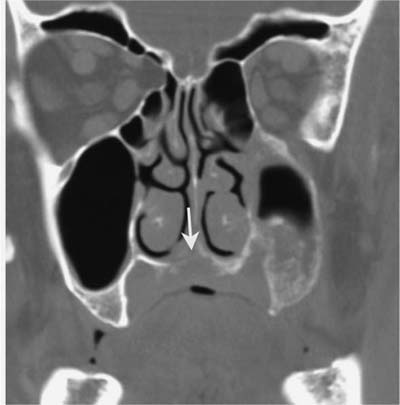 Squamous Cell Carcinoma of the Gingiva and the Hard Palate | Radiology Key